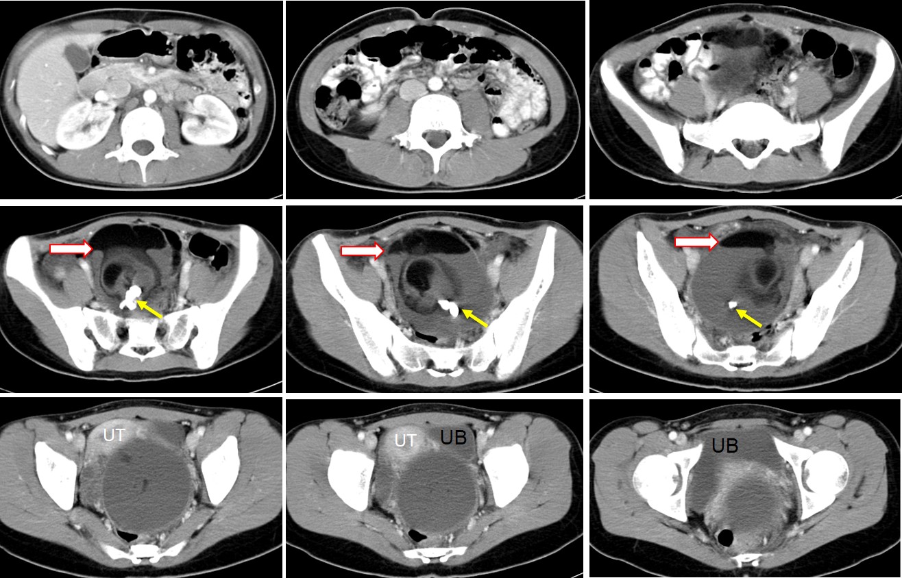 Mature ovarian teratoma – Radiology Cases