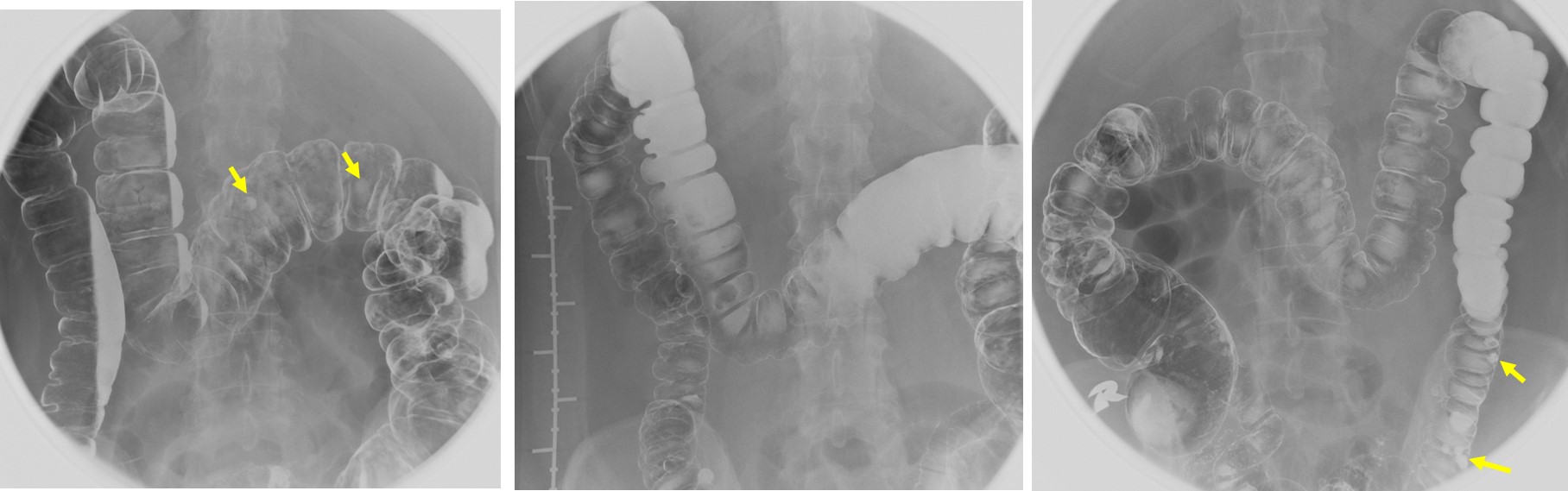 Colonic diverticulosis – Radiology Cases