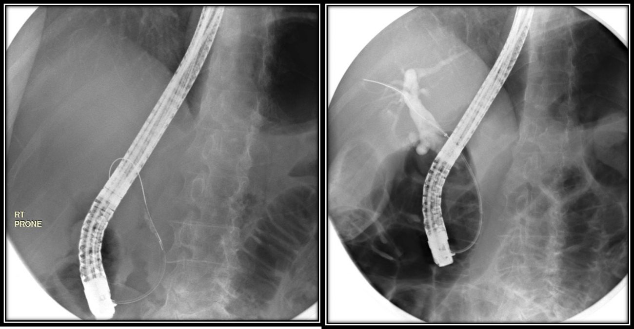 Endoscopic removal of choledocholithiasis – Radiology Cases