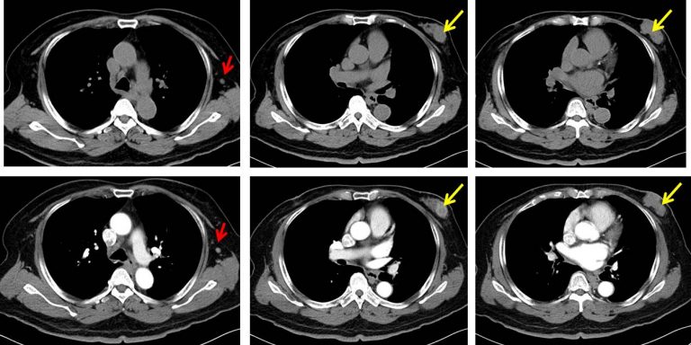 Male breast carcinoma – Radiology Cases