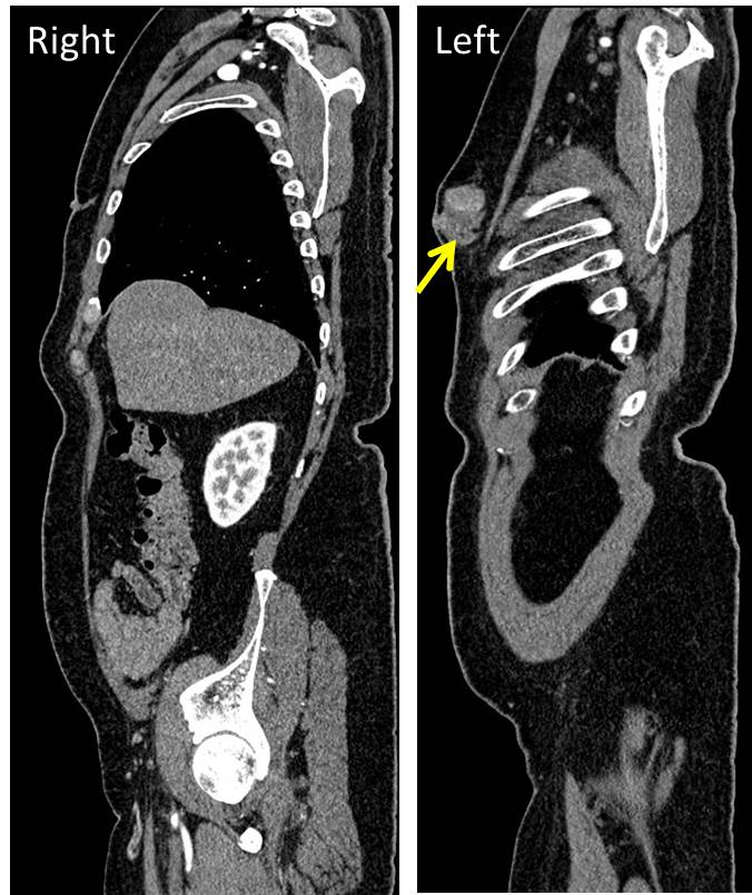 Male breast carcinoma – Radiology Cases