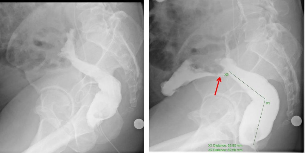 Pneumoperitoneum: Rigler sign – Radiology Cases