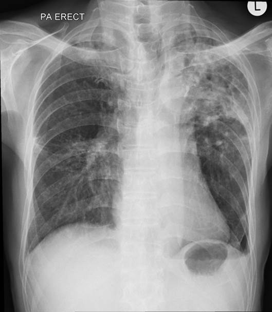 Pulmonary tuberculosis – Radiology Cases