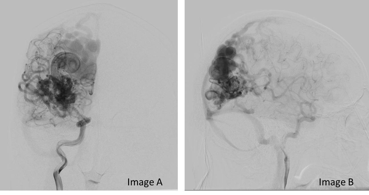 Cerebral arteriovenous malformations – Radiology Cases