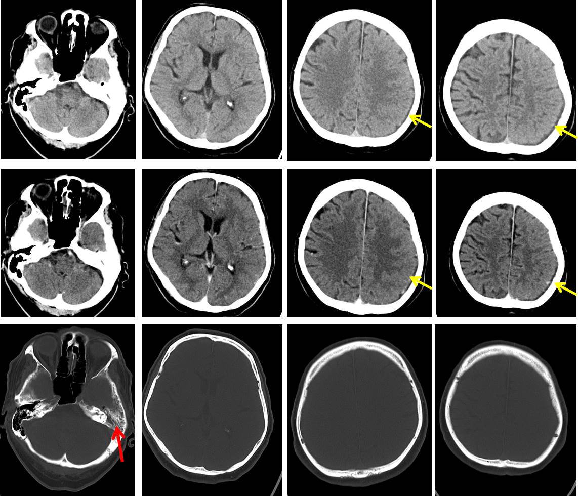 Otomastoiditis complicated with meningitis – Radiology Cases