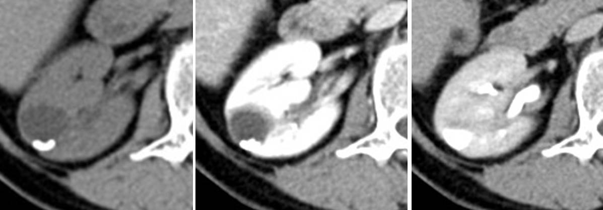 Calyceal diverticulum – Radiology Cases
