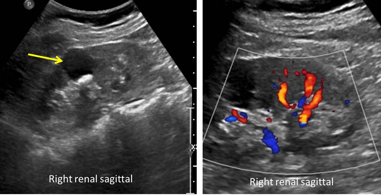 Calyceal diverticulum – Radiology Cases
