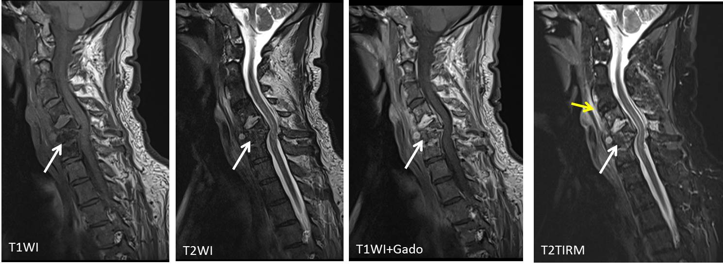Tuberculous spondylitis – Radiology Cases
