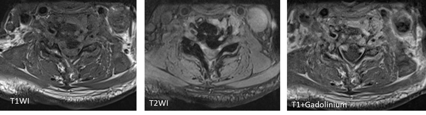 Tuberculous spondylitis – Radiology Cases