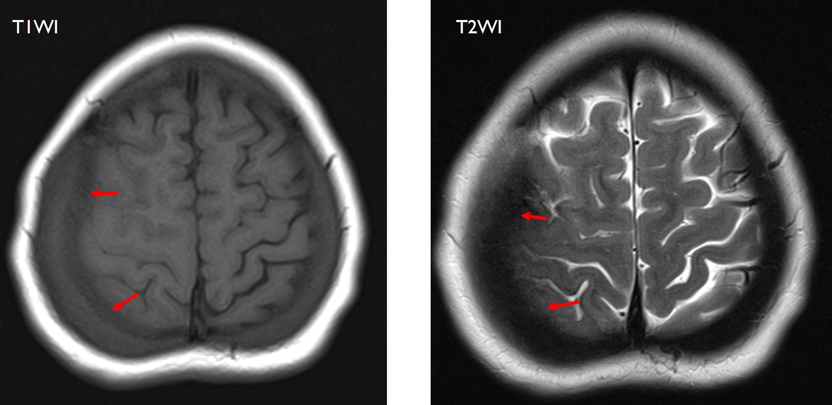 CNS manifestation of SLE – Radiology Cases
