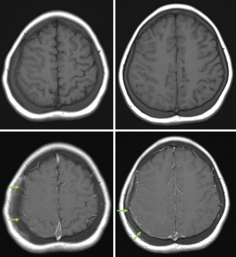 CNS manifestation of SLE – Radiology Cases