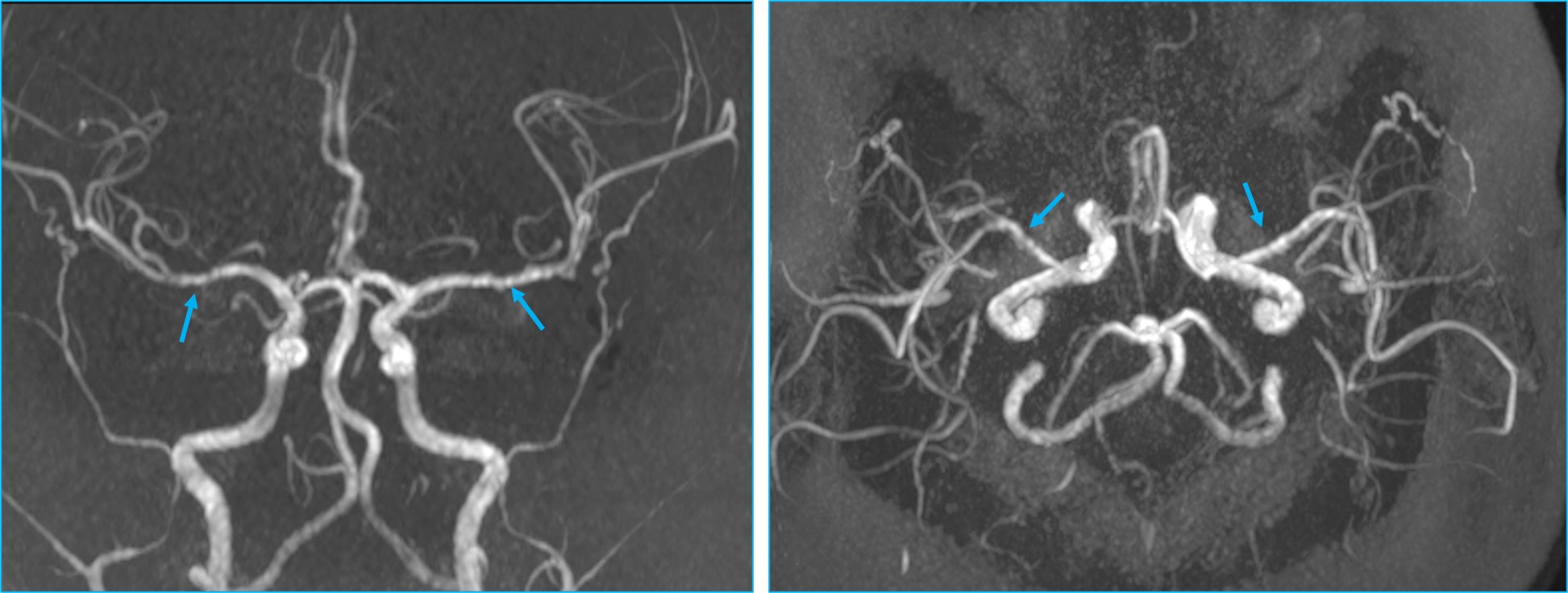 CNS manifestation of SLE – Radiology Cases