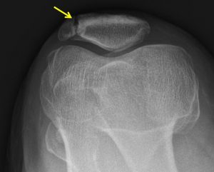 Bipartite patella – Radiology Cases