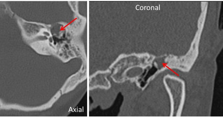 Cholesteatoma – Radiology Cases