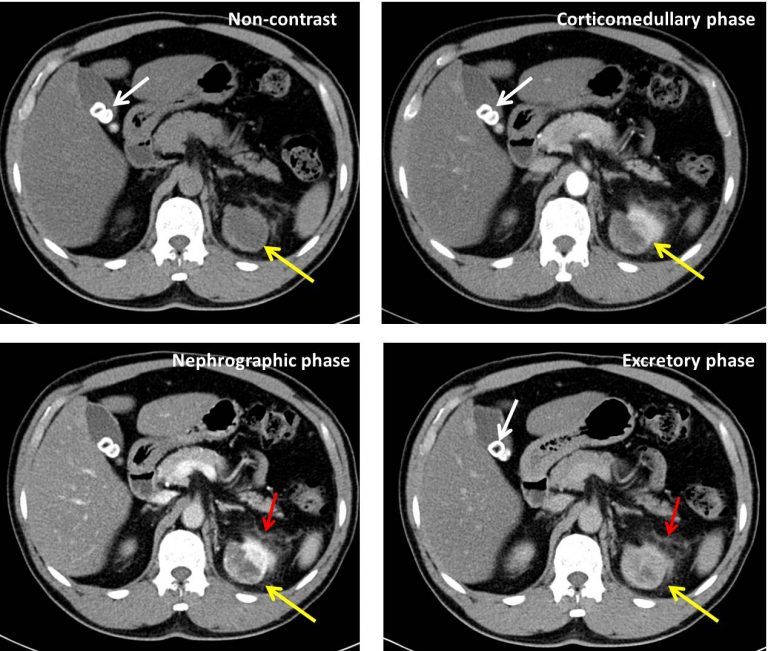 Renal oncocytoma – Radiology Cases