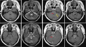 Cerebral abscess – Radiology Cases