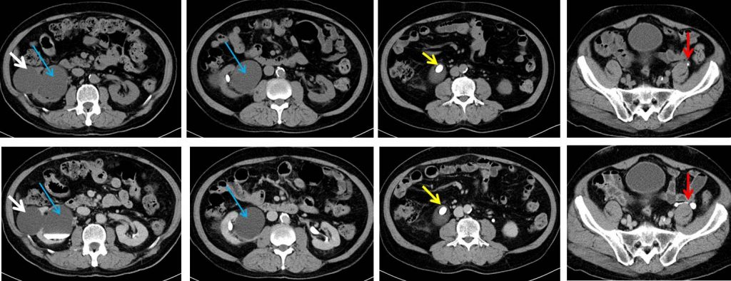Bilateral ureteric calculi – Radiology Cases