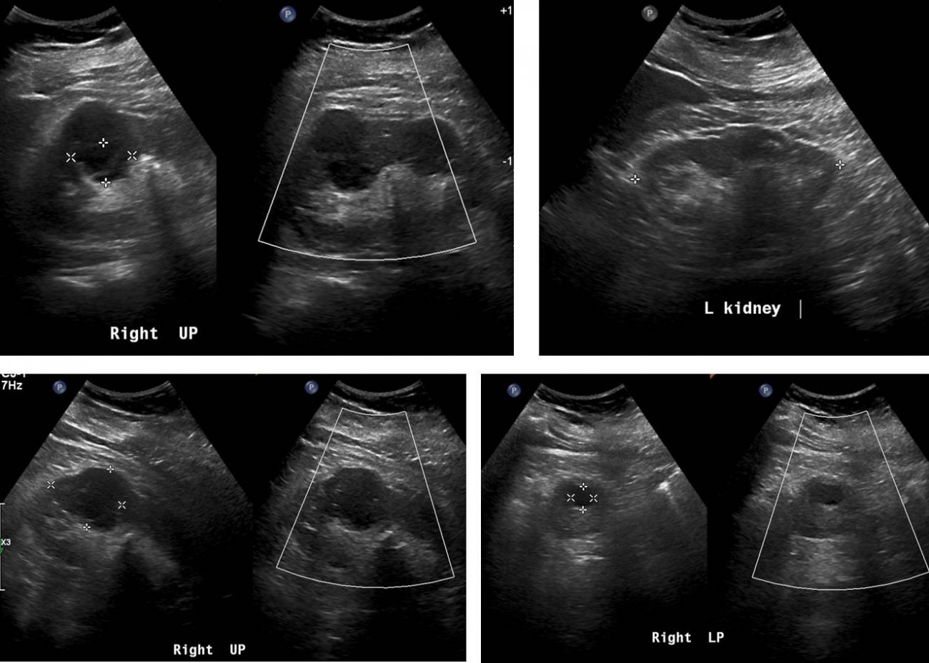 Renal abscesses – Radiology Cases