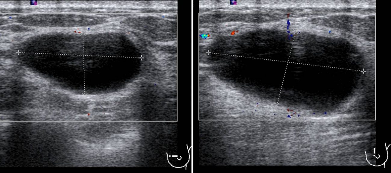 Simple breast cyst – Radiology Cases