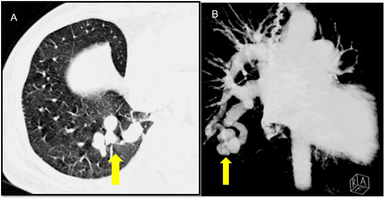 Pulmonary arteriovenous malformation – Radiology Cases