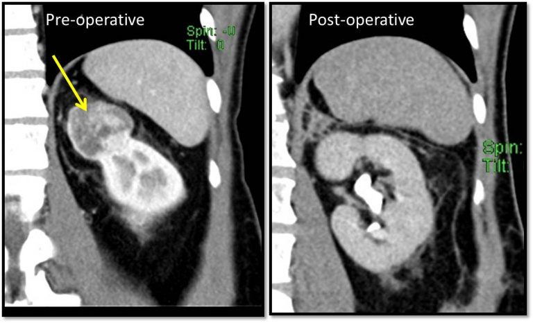 Renal oncocytoma – Radiology Cases