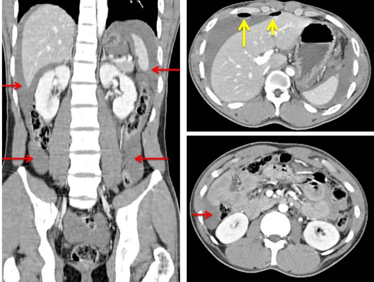 Blunt abdominal trauma: small bowel and mesenteric injuries – Radiology ...