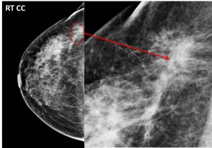 Invasive lobular breast cancer – Radiology Cases