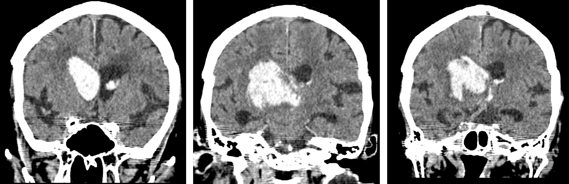Basal ganglia hemorrhage – Radiology Cases