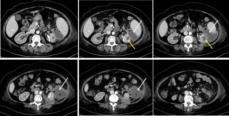 Renal abscess with perinephric extension – Radiology Cases