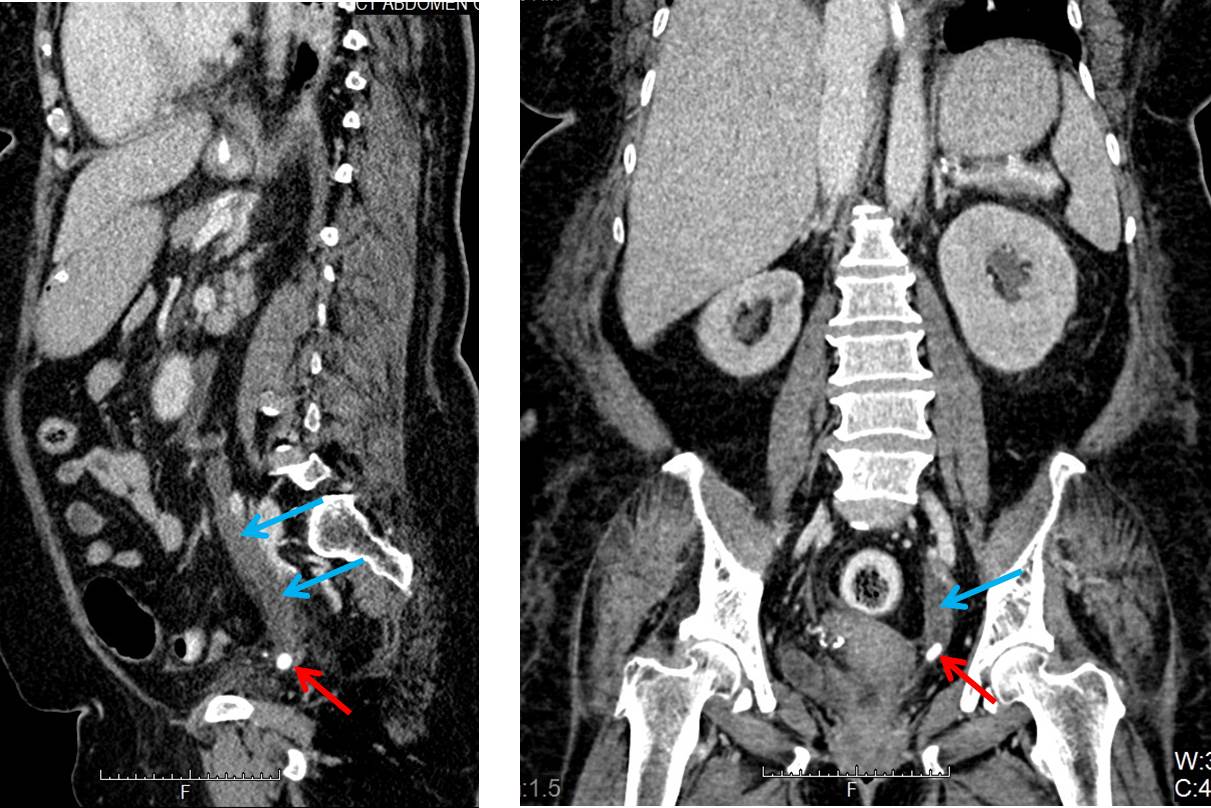 Septic shock due to pyonephrosis – Radiology Cases