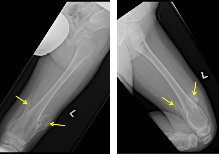 Hereditary multiple exostosis – Radiology Cases