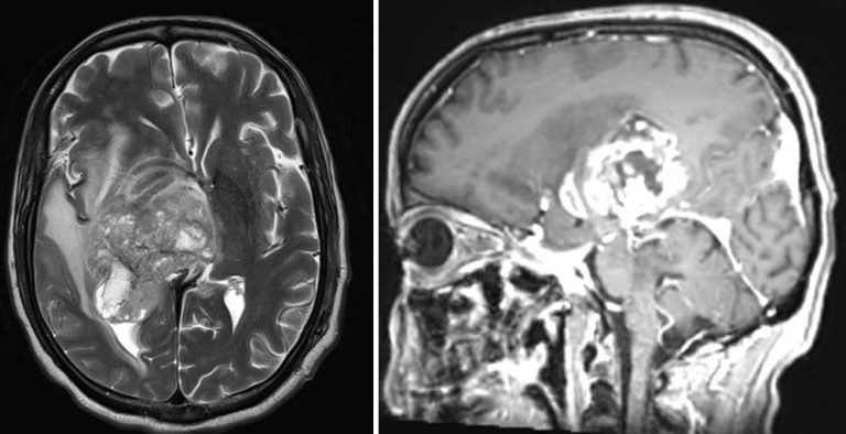 Glioblastoma multiforme – Radiology Cases