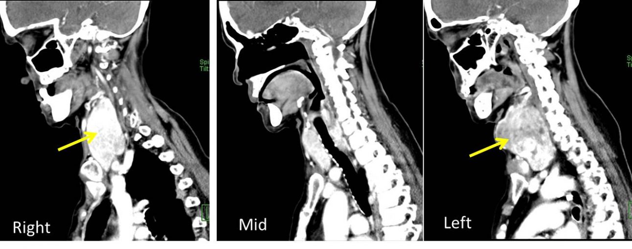 Anaplastic thyroid carcinoma – Radiology Cases