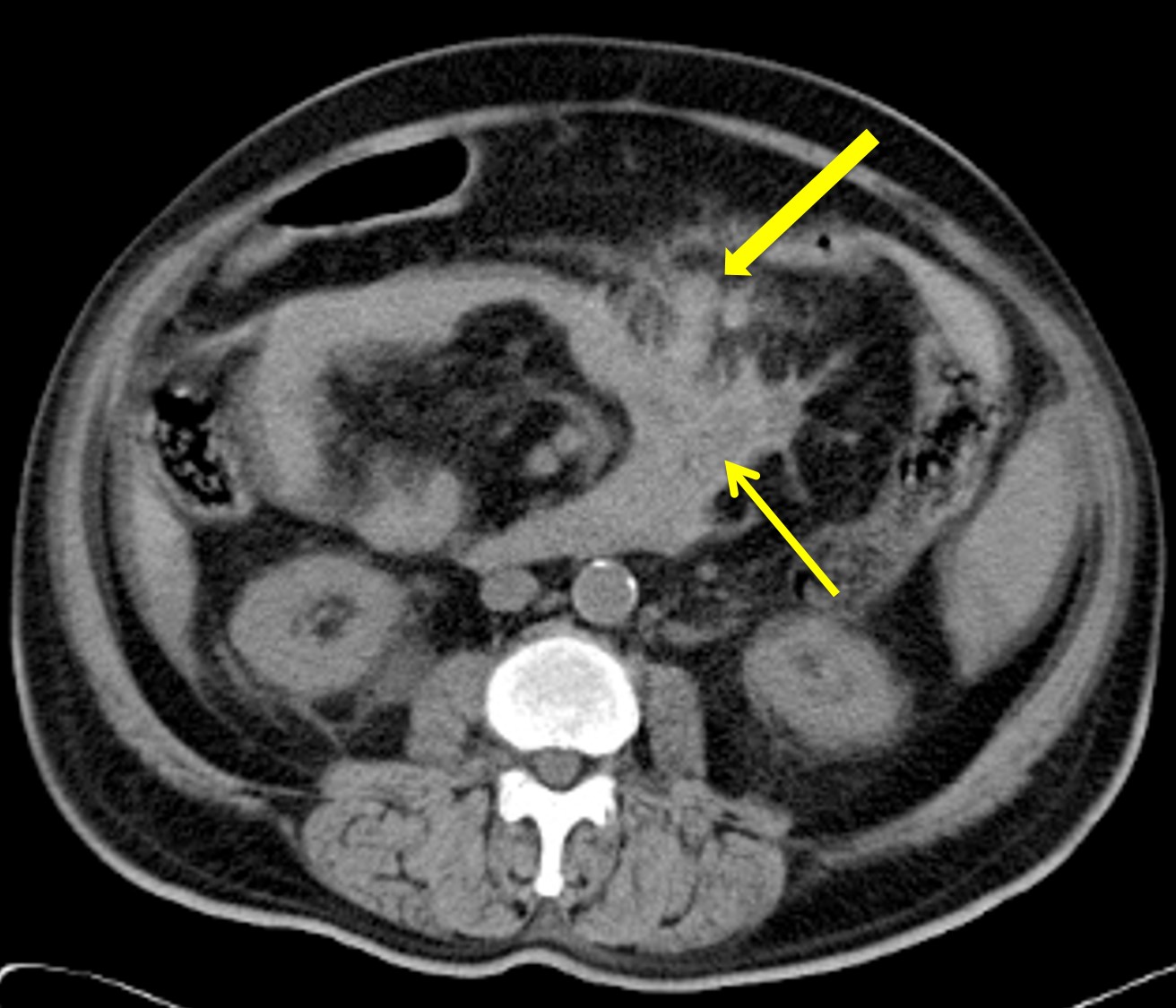 Blunt abdominal trauma: mesenteric injury – Radiology Cases