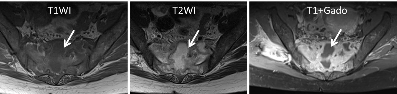 Tuberculous spondylitis – Radiology Cases