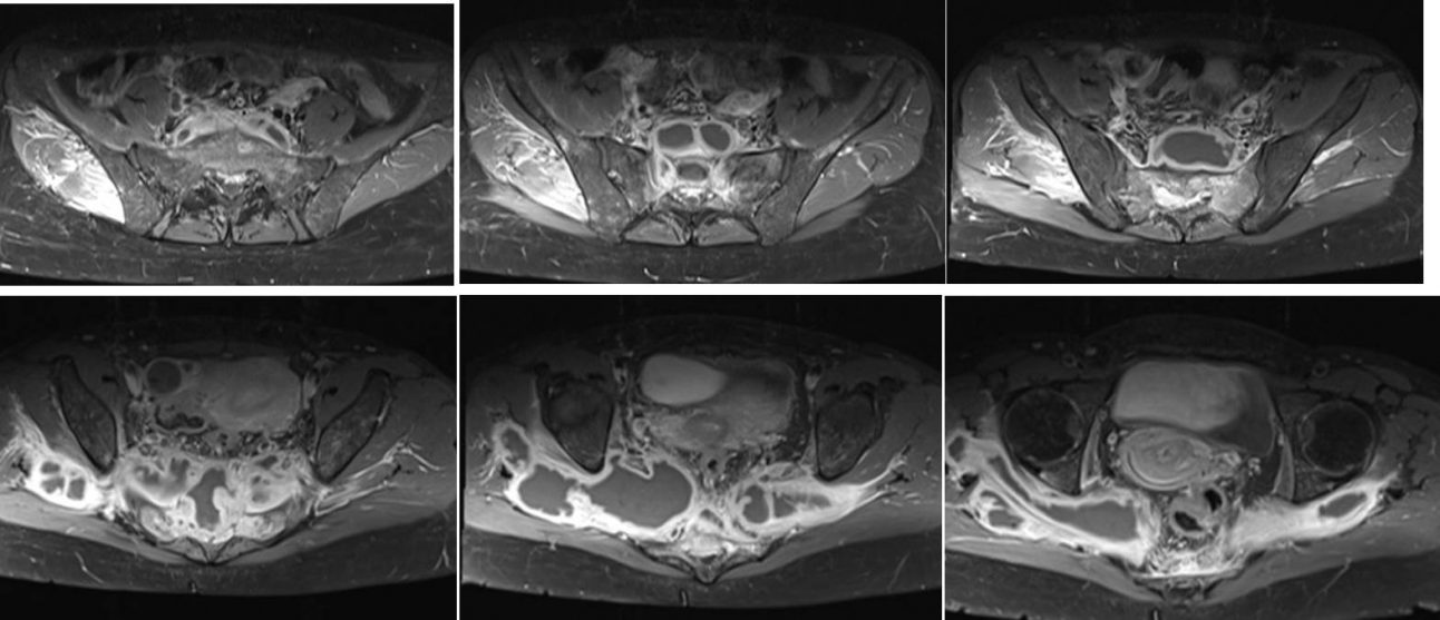 Tuberculous spondylitis – Radiology Cases