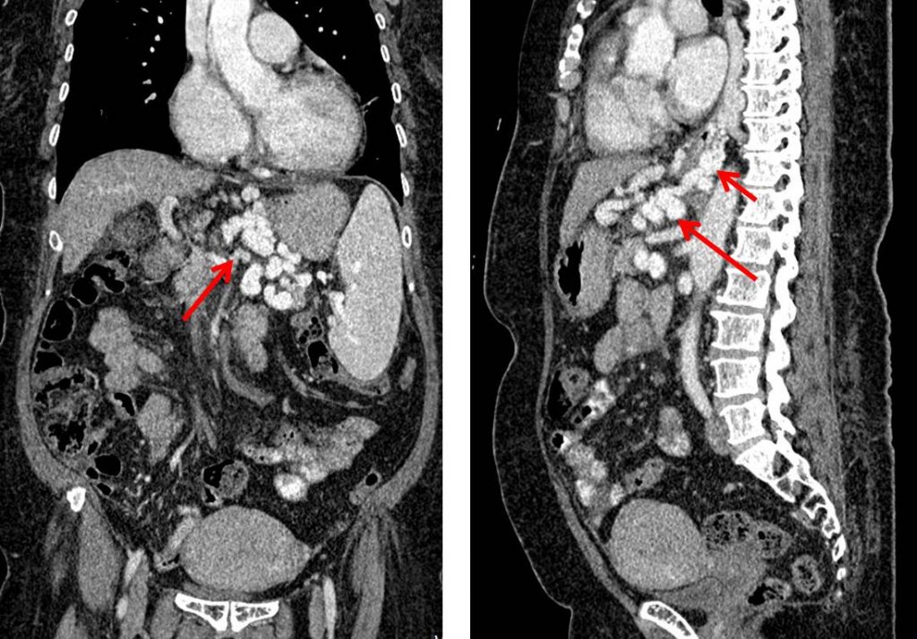 Portal hypertension with portosystemic varices – Radiology Cases