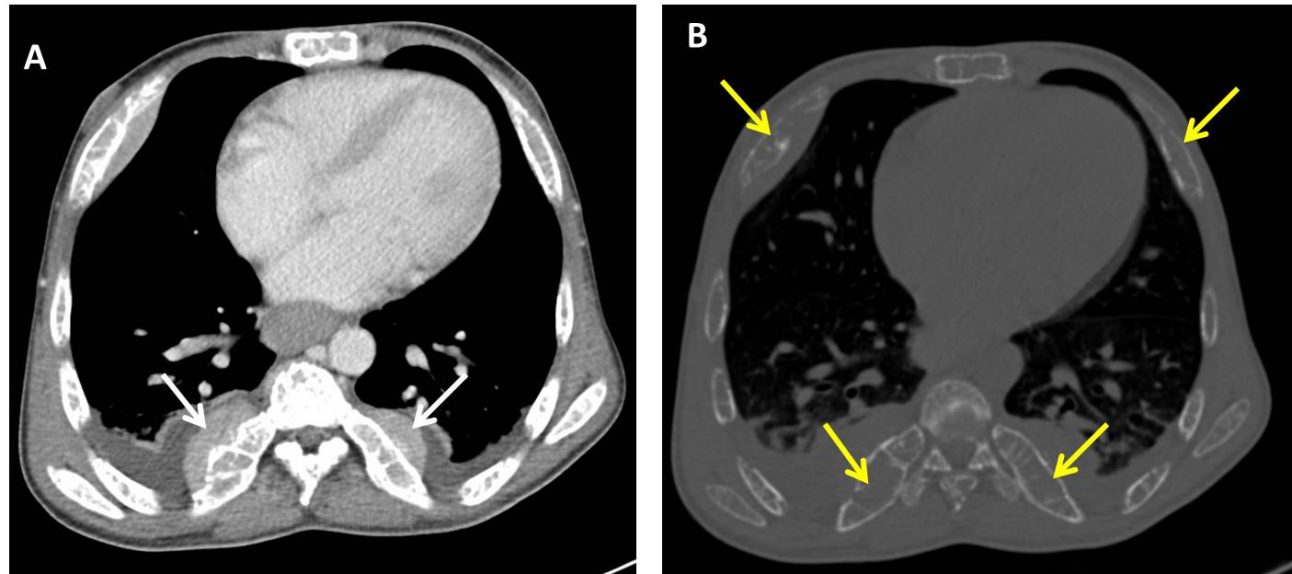 Extramedullary hematopoiesis – Radiology Cases