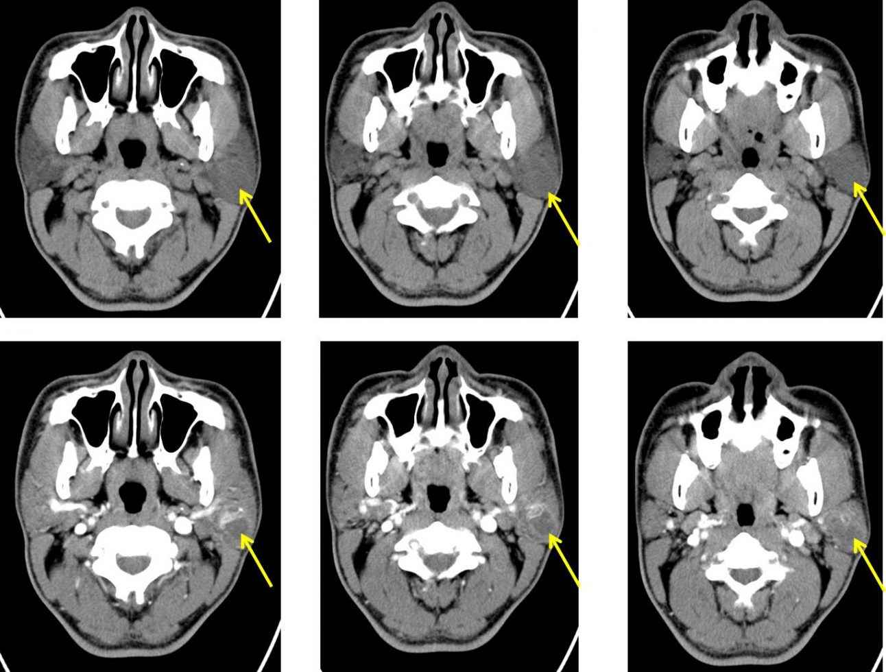 Pleomorphic adenoma of parotid gland – Radiology Cases