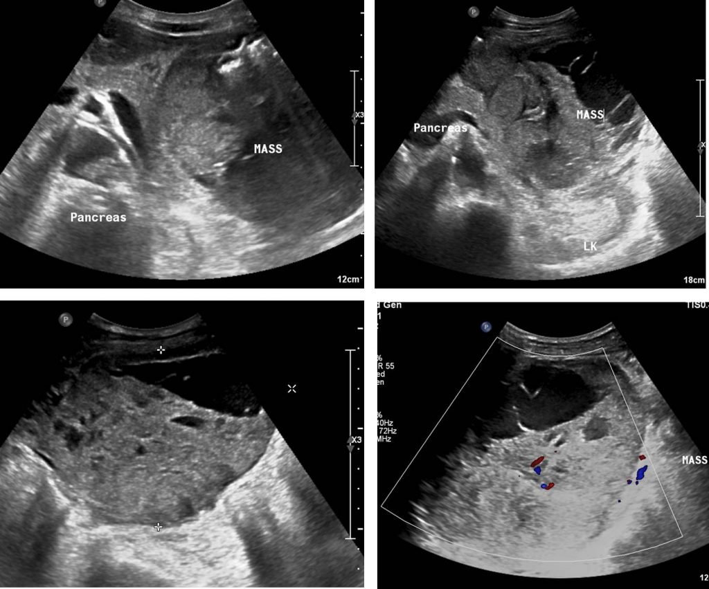Stomach GIST – Radiology Cases