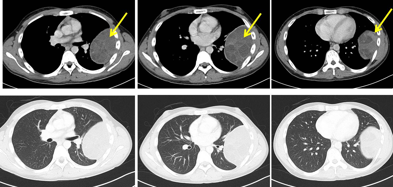 Pleural based mass – Radiology Cases
