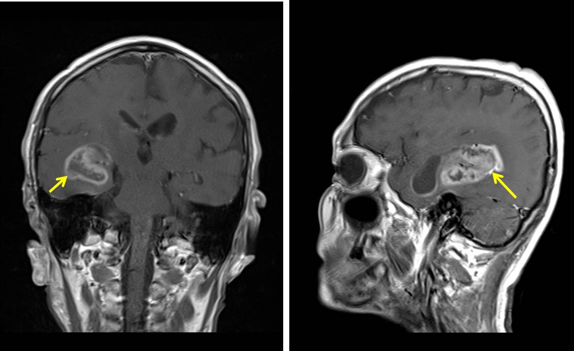 Glioblastoma multiforme – Radiology Cases