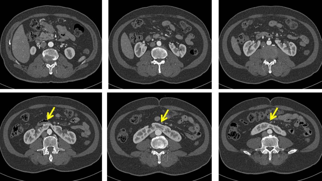 Horseshoe kidney – Radiology Cases