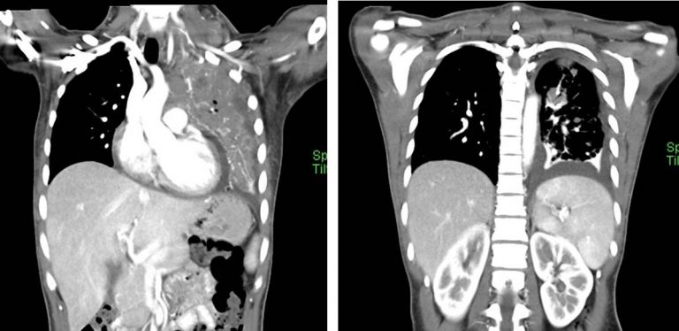 Left upper lobe collapsed – Radiology Cases