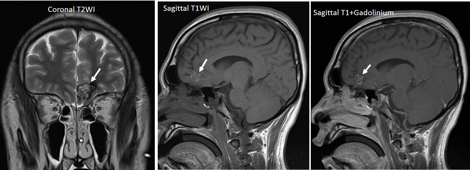 Cerebral cavernous venous malformation – Radiology Cases