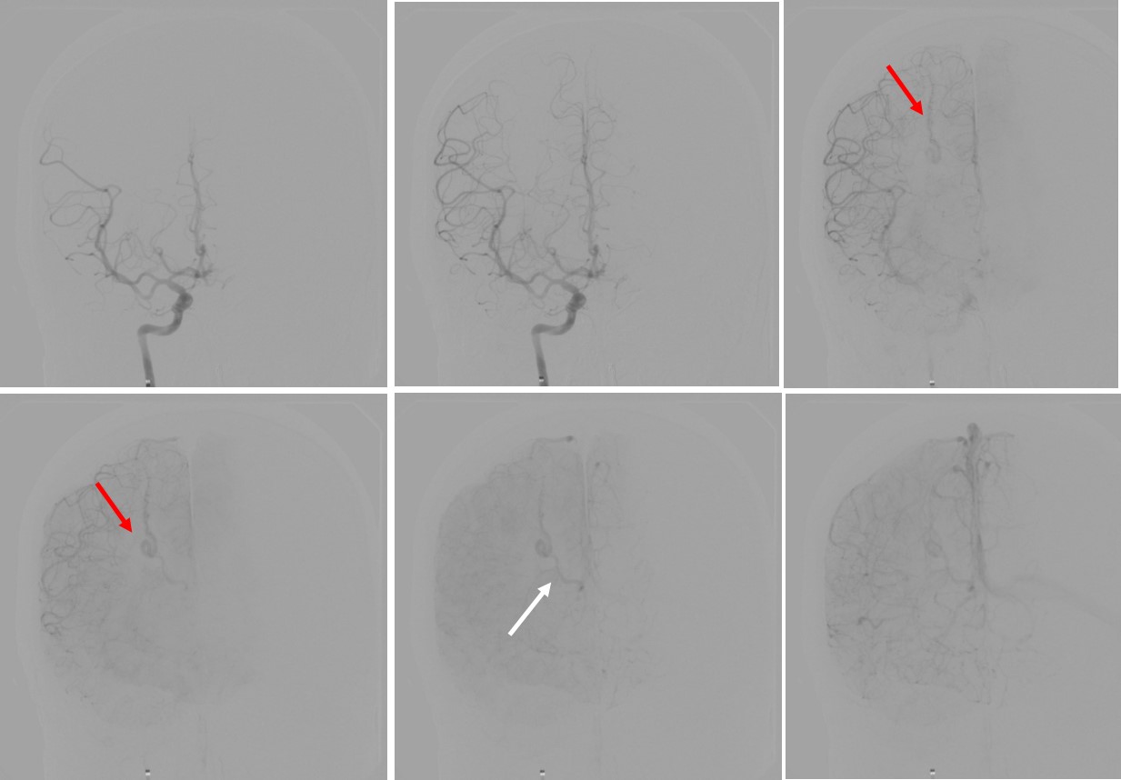 Pial arteriovenous fistula – Radiology Cases