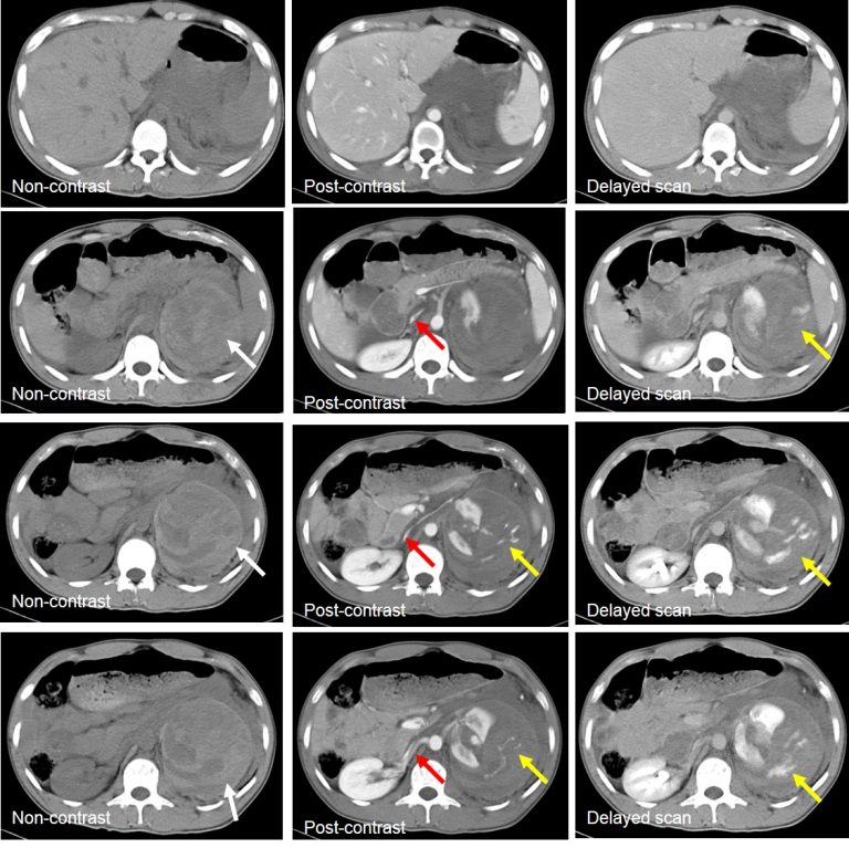 Shattered kidney with active bleed – Radiology Cases