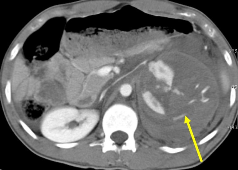 Shattered kidney with active bleed – Radiology Cases