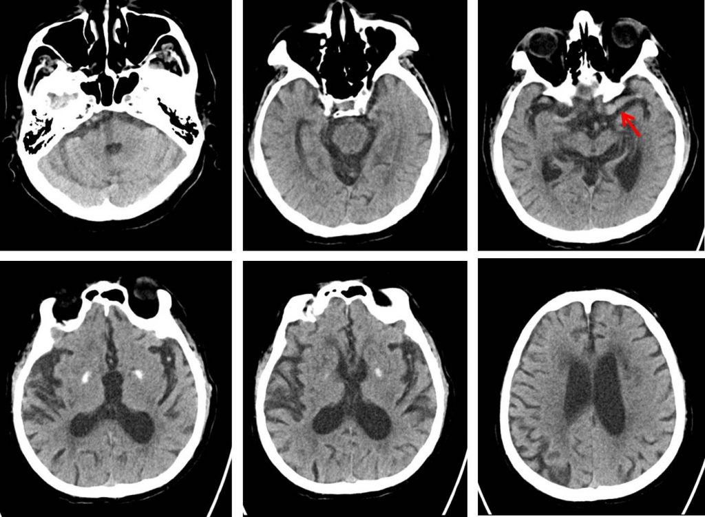 Enlarged perivascular space and fusiform MCA aneursym – Radiology Cases