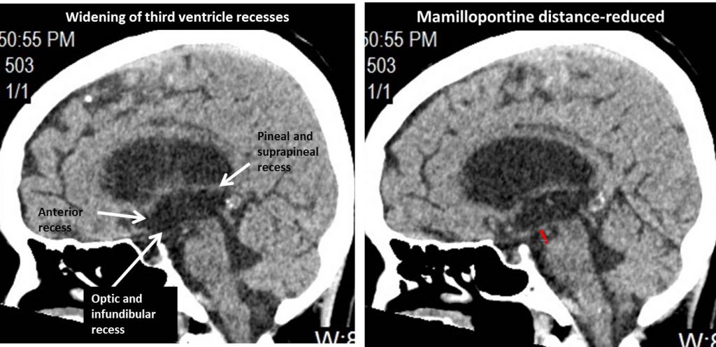Normal pressure hydrocephalus – Radiology Cases